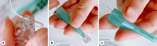 Inverted Placement of Endoscopic One-Way Endobronchial Valve Combined ...