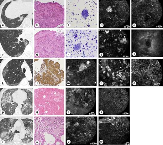 Optical Biopsies Using Probe-Based Confocal Laser Endomicroscopy for ...