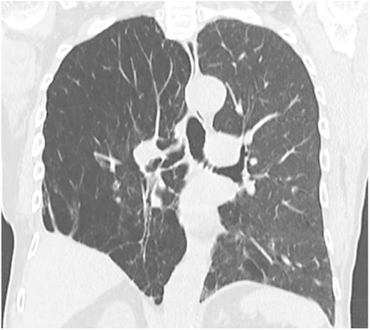 Bronchiolitis in Adults: Etiology, Diagnostic, and Therapeutic Approach ...