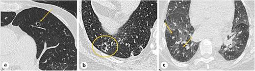 Bronchiolitis in Adults: Etiology, Diagnostic, and Therapeutic Approach ...