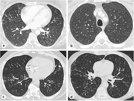 Bronchiolitis in Adults: Etiology, Diagnostic, and Therapeutic Approach ...