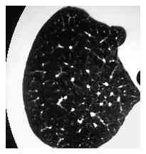 Diagnostic Imaging of Diffuse Infiltrative Disease of the Lung ...