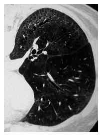 Diagnostic Imaging of Diffuse Infiltrative Disease of the Lung ...