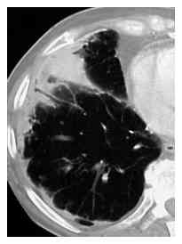 Diagnostic Imaging of Diffuse Infiltrative Disease of the Lung ...