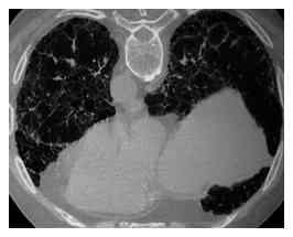 Diagnostic Imaging of Diffuse Infiltrative Disease of the Lung ...