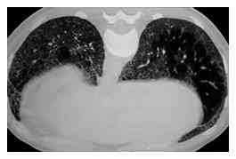 Diagnostic Imaging of Diffuse Infiltrative Disease of the Lung ...
