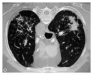 Diagnostic Imaging of Diffuse Infiltrative Disease of the Lung ...