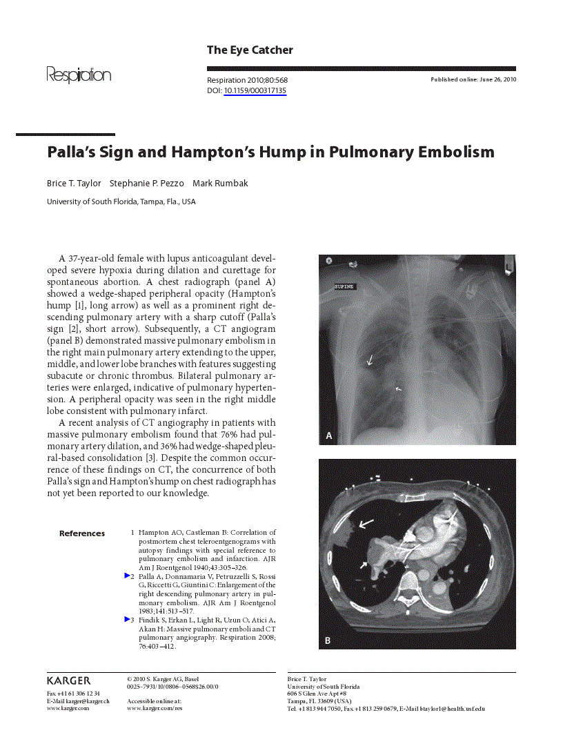 Palla’s Sign and Hampton’s Hump in Pulmonary Embolism | Respiration ...