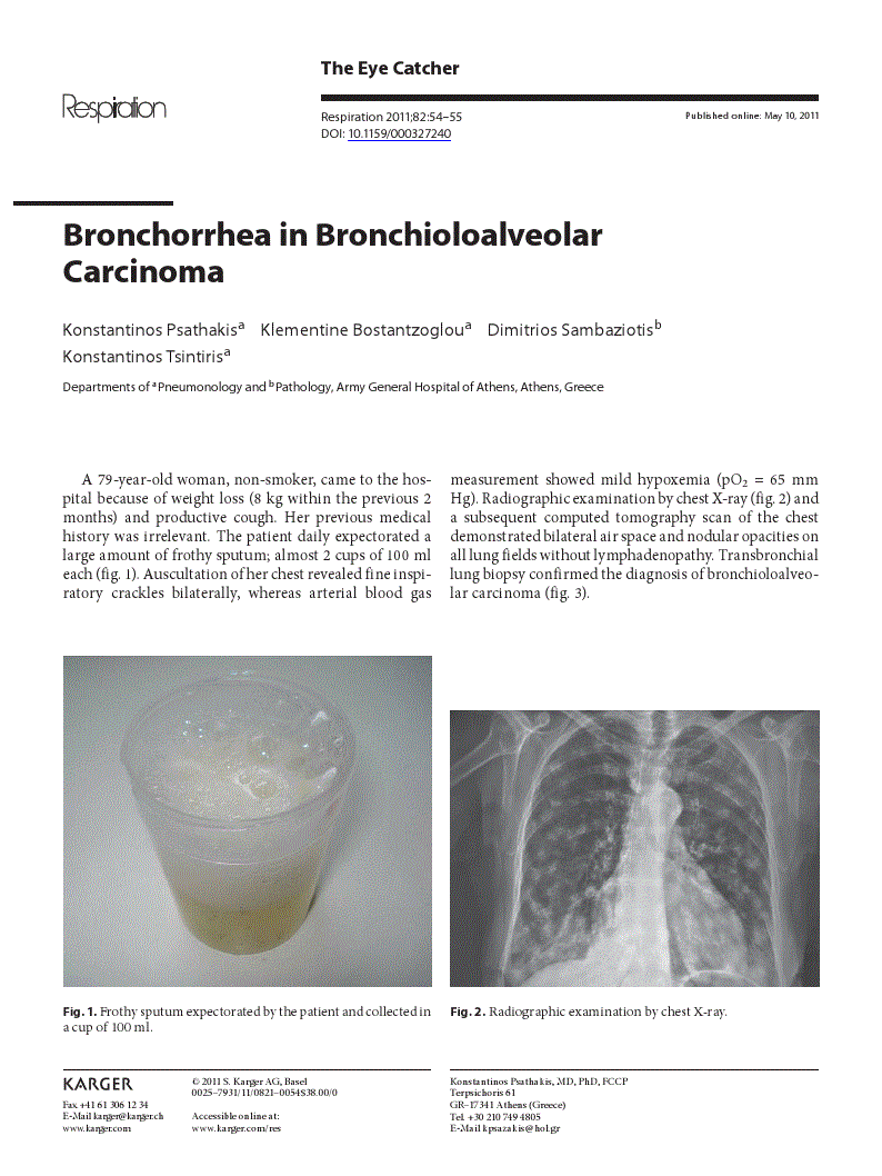 Bronchorrhea in Bronchioloalveolar Carcinoma | Respiration | Karger ...