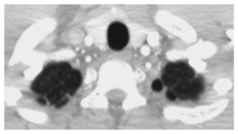Pneumothorax and Bullae in Marfan Syndrome | Respiration | Karger ...