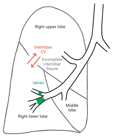 Collateral Ventilation | Respiration | Karger Publishers