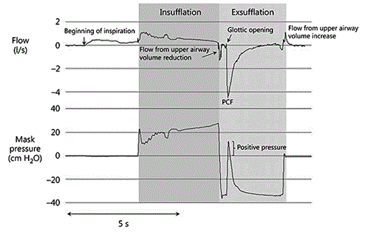 Comparison of Three Cough-Augmentation Techniques in Neuromuscular ...
