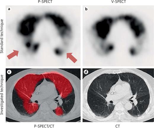 Diagnosis of Pulmonary Embolism: Conventional Ventilation/Perfusion ...