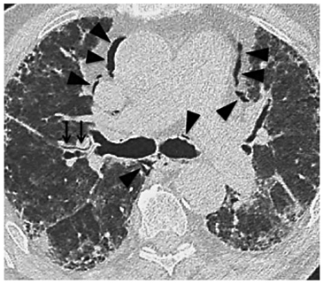 Spontaneous Pneumomediastinum as a Potential Predictor of Mortality in ...
