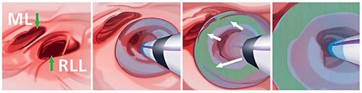 Endobronchial Valves for Endoscopic Lung Volume Reduction: Best ...