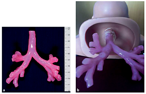 Realistic 3D-Printed Tracheobronchial Tree Model from a 1-Year-Old Girl ...