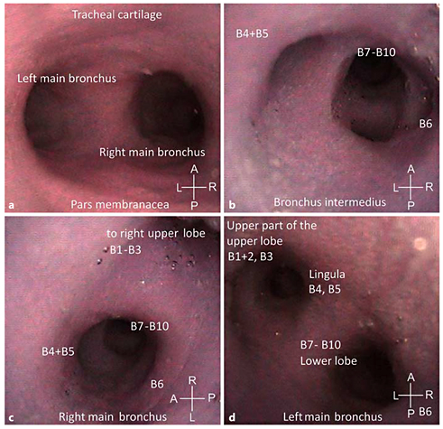 Realistic 3D-Printed Tracheobronchial Tree Model from a 1-Year-Old Girl ...