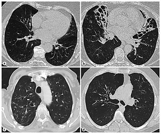Patterns of Disease in Patients with Middle-Lobe Predominant ...
