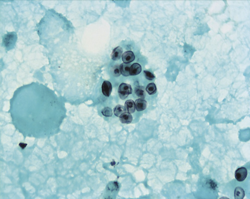 Clinical, Diagnostic, and Treatment Disparities between HIV-Infected ...