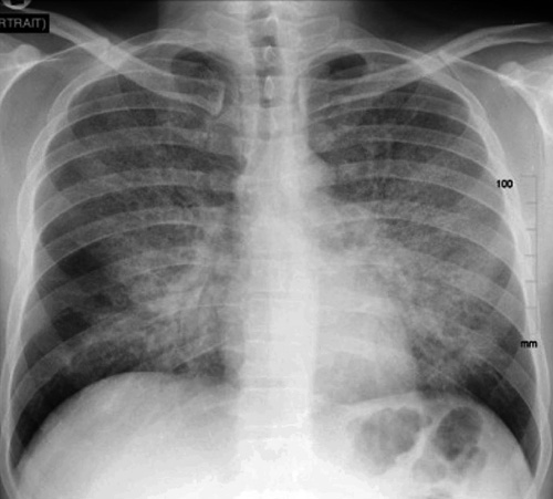 Clinical, Diagnostic, and Treatment Disparities between HIV-Infected ...
