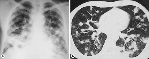 Diagnosis and Management of Systemic Endemic Mycoses Causing Pulmonary ...