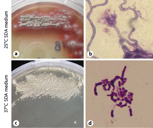 Diagnosis and Management of Systemic Endemic Mycoses Causing Pulmonary ...