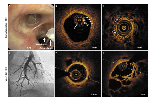 Advances in Optical Coherence Tomography and Confocal Laser ...