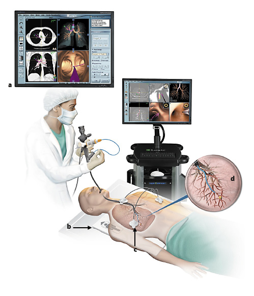 Navigation Bronchoscopy | Respiration | Karger Publishers
