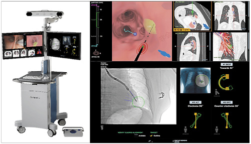 Navigation Bronchoscopy | Respiration | Karger Publishers