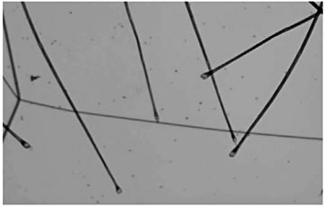 Hair That Does Not Grow | Skin Appendage Disorders | Karger Publishers