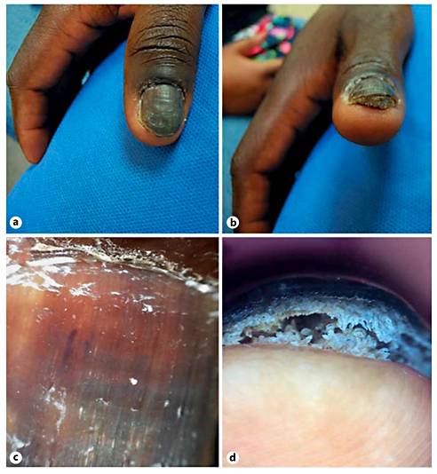 Onychomycosis and Onychomatricoma | Skin Appendage Disorders | Karger ...