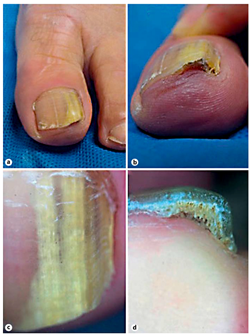 Onychomycosis and Onychomatricoma | Skin Appendage Disorders | Karger ...