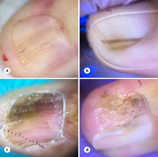 Update on Squamous Cell Carcinoma of the Nail Unit: An Human ...