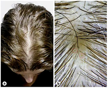 Differential Diagnosis of Female-Pattern Hair Loss | Skin Appendage ...
