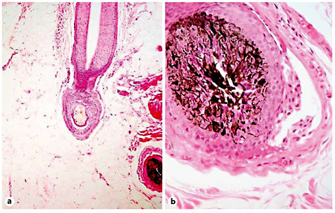 Differential Diagnosis of Female-Pattern Hair Loss | Skin Appendage ...