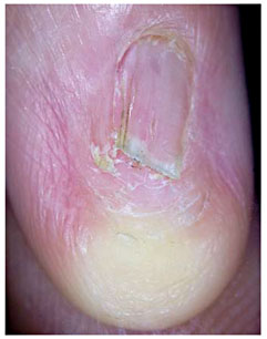 Dermoscopy in the Evaluation of Nail Disorders | Skin Appendage ...