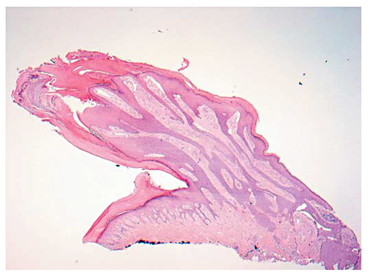 An Unusual Periungual Lesion | Skin Appendage Disorders | Karger Publishers