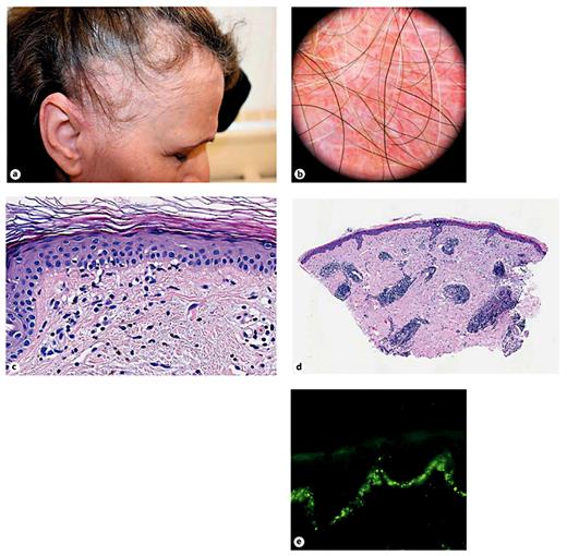 Cutaneous Lupus Erythematosus Presenting as Frontal Fibrosing Alopecia ...