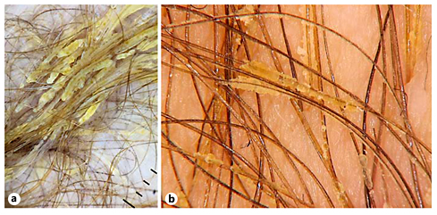 Dermoscopy of Yellow Concretions on Axillary Hair | Skin Appendage ...