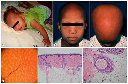 Atrichia with Papular Lesions: Importance of Histology at an Early ...