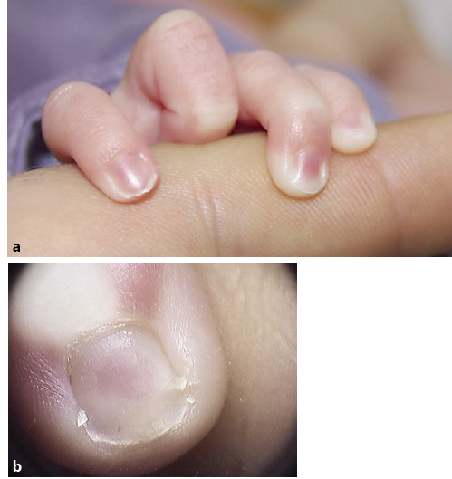 Nail Disorders in Children | Skin Appendage Disorders | Karger Publishers