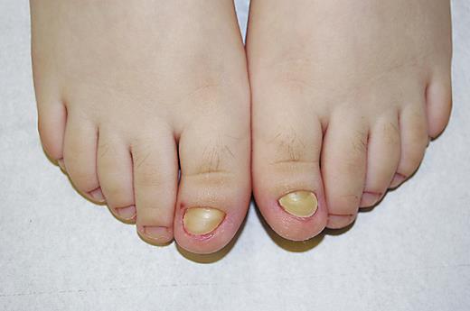 Nail Disorders in Children | Skin Appendage Disorders | Karger Publishers