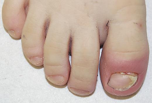 Nail Disorders in Children | Skin Appendage Disorders | Karger Publishers