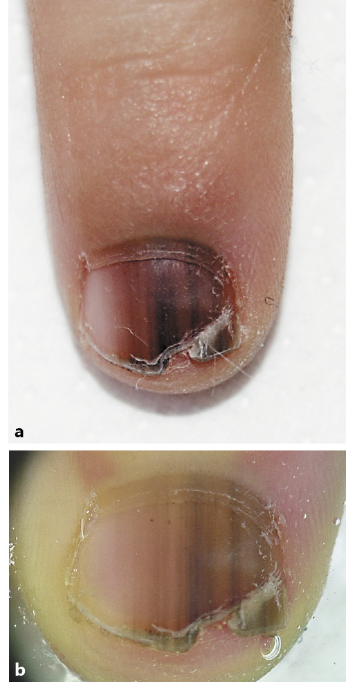 Nail Disorders in Children | Skin Appendage Disorders | Karger Publishers