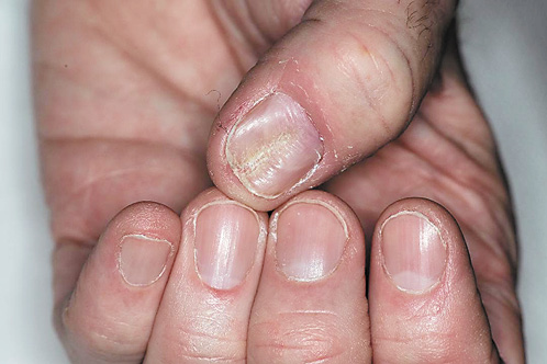 Alopecia Areata and Habit Tic Deformities | Skin Appendage Disorders ...