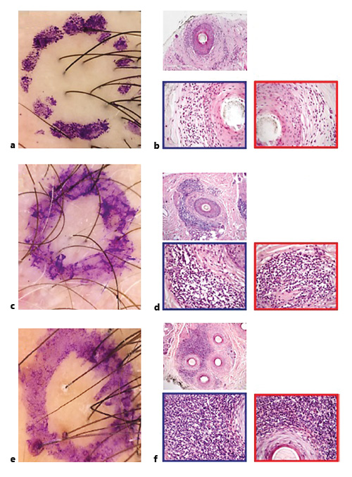 Frontal Fibrosing Alopecia Severity Index: A Trichoscopic Visual Scale ...