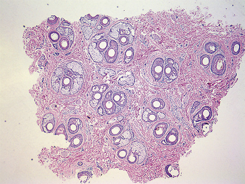 Quantification of Hair Follicles in the Scalp in Mexican Mestizo ...