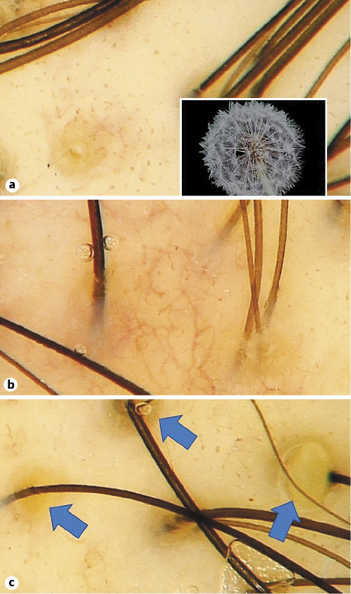 Seborrheic Dermatitis: Three Novel Trichoscopic Signs and Its ...