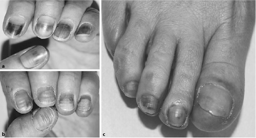 Management and Outcome of Taxane-Induced Nail Side Effects: Experience ...