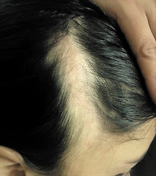 Linear Patch of Alopecia in a Child: Trichoscopy Reveals the Actual ...